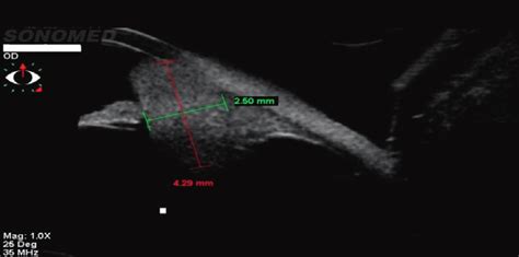 Ubm Showed A Solid Mass With Highmedium Reflectivity And Loss Of The Download Scientific