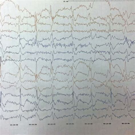Eeg Showing Background Activity Of Diffuse Generalized Symmetric