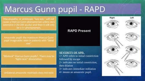 Trastornos De La Pupila Disorders Of Pupil Pptx