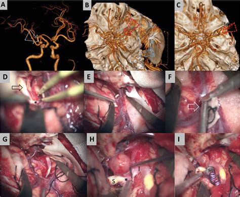 Figure 2 From Early Exposure Of The Dorsal Surface Of M1 Segment Via The Distal Transsylvian