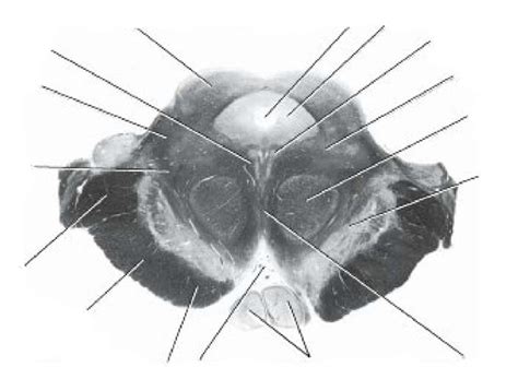 Transverse Section Of The Midbrain At The Level Of The Superior