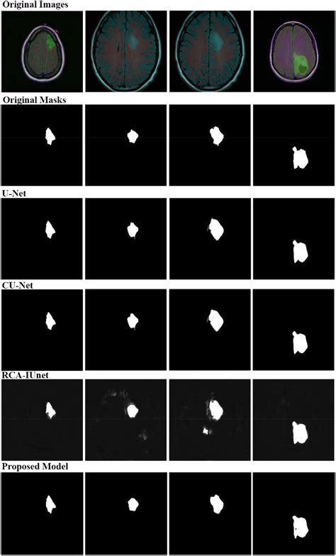 aml‐net attention‐based multi‐scale lightweight model for brain tumour