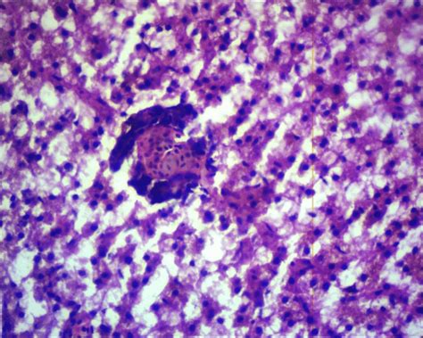 A Photomicrograph 40x Magnification Showing Hypertrophy And