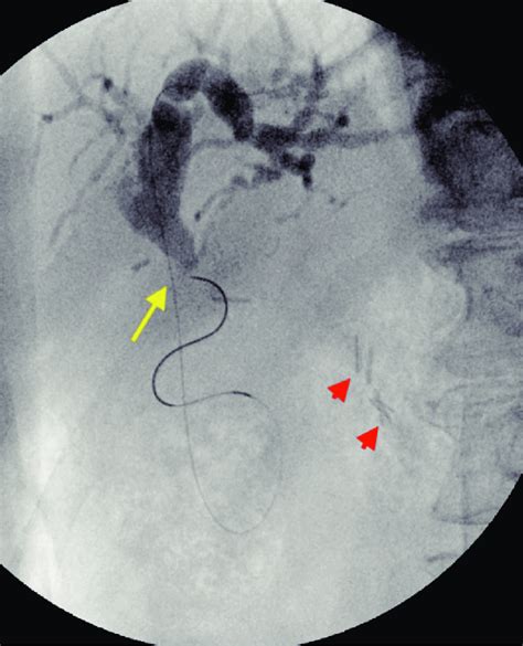 Fluoroscopy Showing Wire Passage Across The Hepaticojejunal Anastomosis