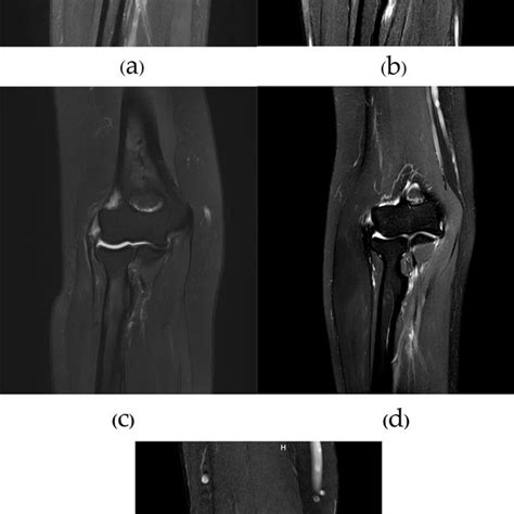 Mri Illustration For The Degree Of Common Extensor Tendon Injuries The Download Scientific