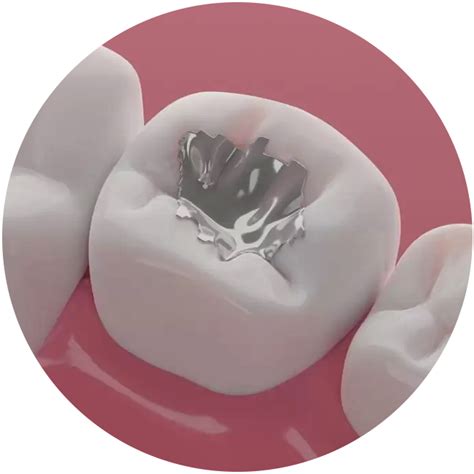 Amalgam Fillings Bowling Green Ky Sky Pediatric Dentistry