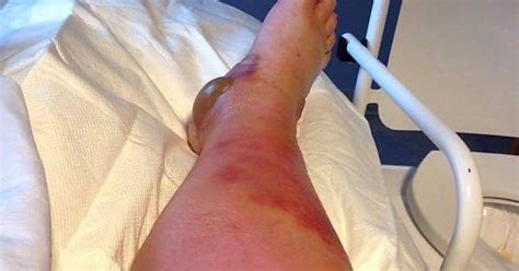 Strep B Infection Progression Album On Imgur