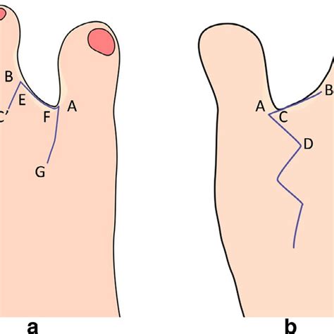 Blauth And Borisch Classification Of Cleft Foot Download Scientific