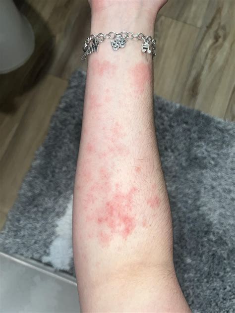 Rash Wont Go Away On Arm And Hand R Dermatologyquestions