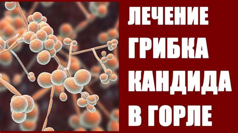 ЛЕЧЕНИЕ ГРИБКА КАНДИДА В ГОРЛЕ. ПРИЗНАКИ КАНДИДОЗА. ПЕРШЕНИЕ В ГОРЛЕ ...