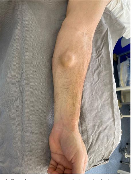 Figure 1 From Superficial Ulnar Artery Pseudoaneurysm Semantic Scholar