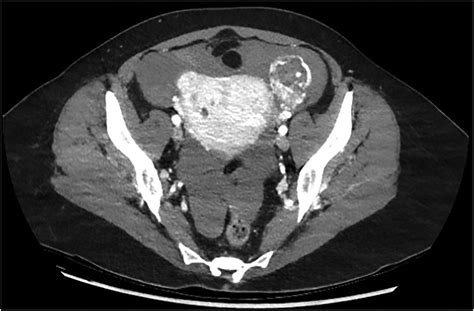 Ruptured Ectopic Pregnancy Ultrasound