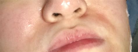 Bleach Burn In Nose At Ronald Whitehurst Blog