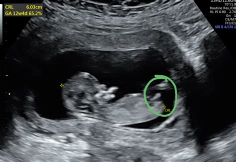 What Does A Boy Ultrasound Look Like At 12 Weeks
