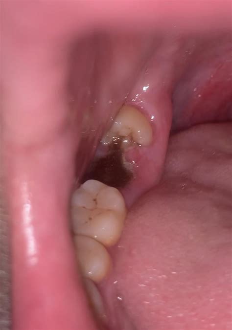 Extractions Issue And Worry 😢 Raskdentists