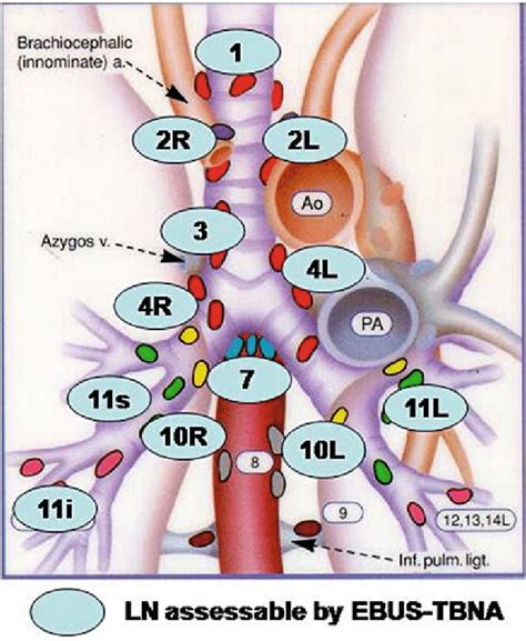 Mediastinal Lymph Node Levels