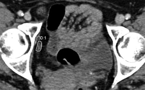 Normal Appendix In Adults Reproducibility Of Detection With Unenhanced