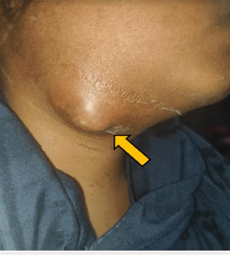 Swelling In The Right Submandibular Region With Erythema With Raised Download Scientific