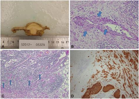 Pathologic Findings A Gross Findings After Segmental Colon Resection