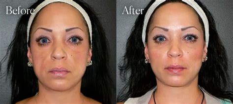 Cheek Implant Before And After Denver Co Shah Aesthetic Surgery