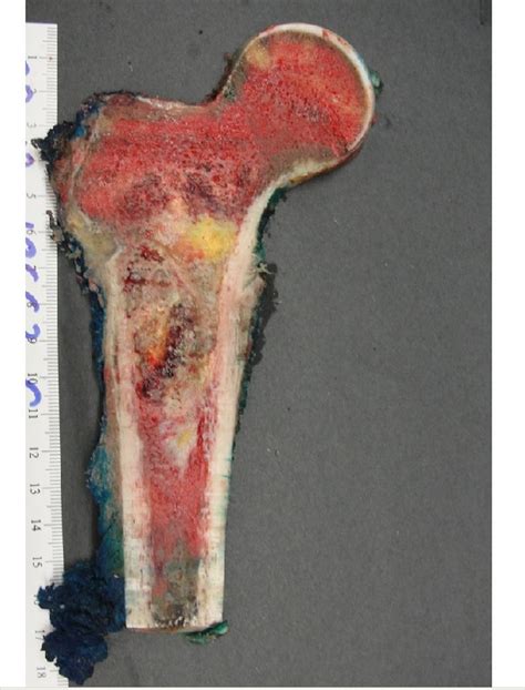 Florid Reactive Periostitis