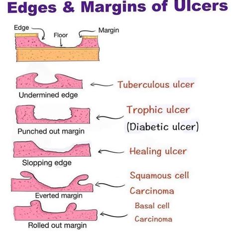 Medicina Edges Of Ulcers Punched Out → Syphilis