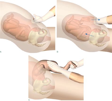 Cesarean Section Technique With Diagram