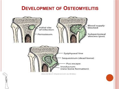 Osteomyelitis Pptx