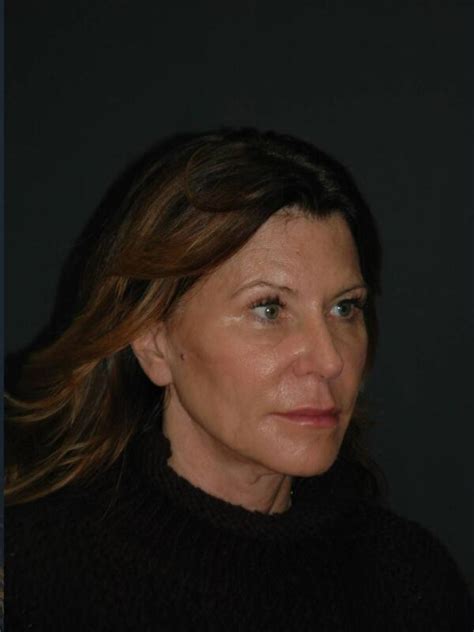 Blepharoplasty Before And After Patient 13