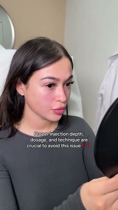 Bulging After Masseter Botox Aestheticnurse Botoxm Beauty Youtube