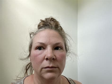 Anyone Get Facial Swelling This Is Not Lupus Right Rlupus