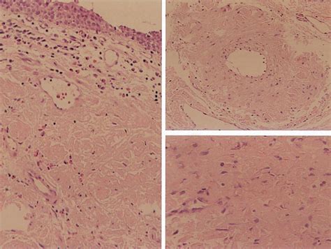 A Amorphous Eosinophilic Amyloid Deposits Within The Bladders My