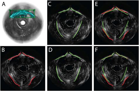 intensity based volumetric registration on pubic bone voi a a cubic