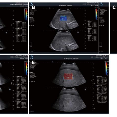 Transient Elastography Fibroscan ® A For The Evaluation Of Normal