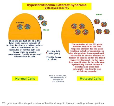 My Post Weekly Hereditary Hyperferritinemia Catarct Syndrome Or Hhcs