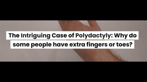 The Intriguing Case Of Polydactyly Why Do Some People Have Extra