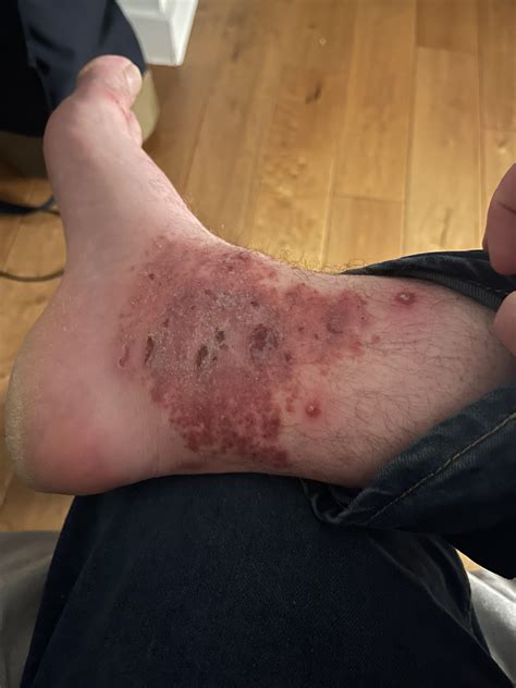 I Have Psoriasis But Had A Major Flare Up A Couple Months Ago This