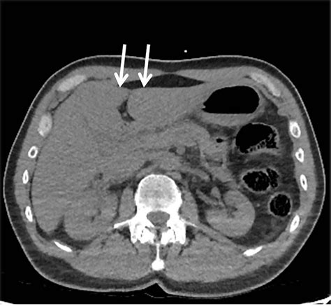 Falciform Ligament Ultrasound