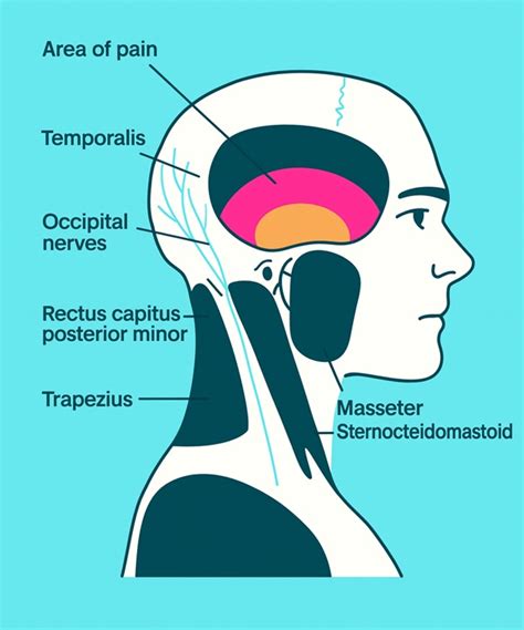 How Neck Pain Can Cause Headaches Insights Causes And Treatments