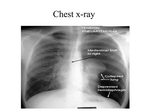 Tension Pneumothorax And Chest Trauma Pptx Pptx