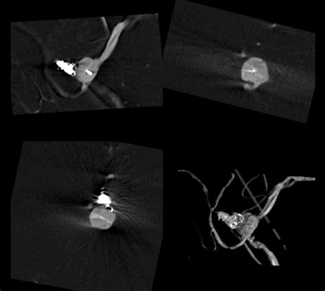 Web Coil Of A Ruptured Daca Aneurysm