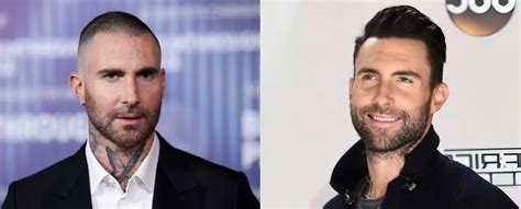 Celebrity Hair Transplants 45 Transformations And Success Stories