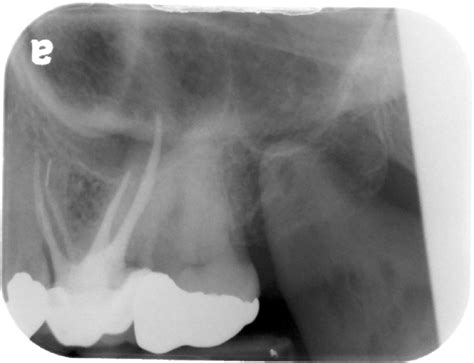Anatomy Monday Coronoid Process Mandible Dr Gs Toothpix