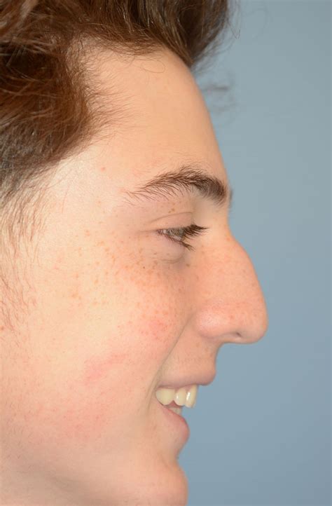 Sinus Surgery 2 Robert A Guida Md Pc