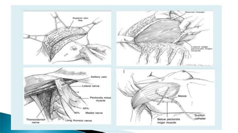 Modified Radical Mastectomy Pptx