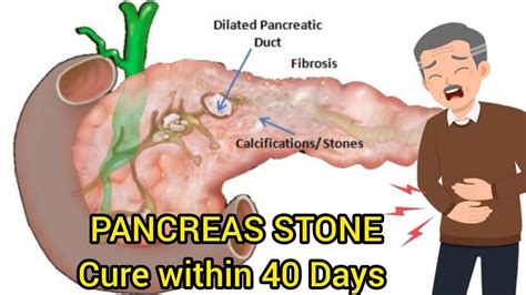 Pancreas Stone Cure Within 40 Days Youtube