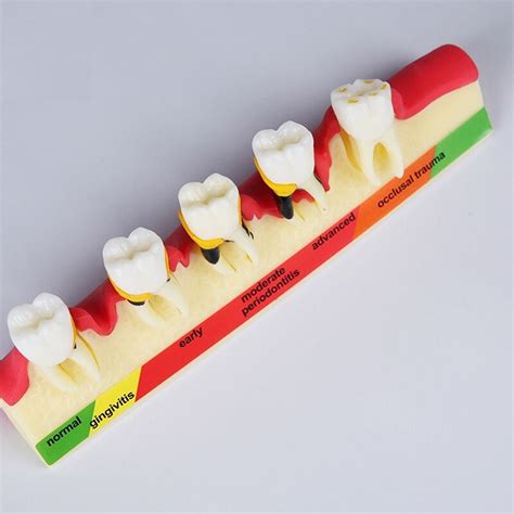 Dental Caries Disease Teeth Model M4010 Dental Edu Grandado