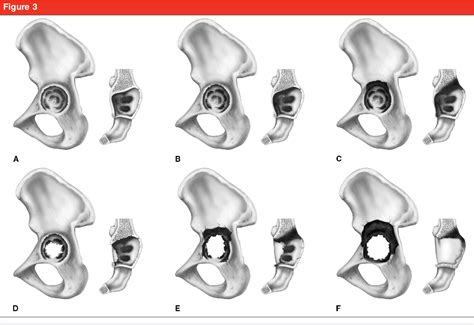 Figure 3 From Acetabular Bone Loss In Revision Total Hip Arthroplasty