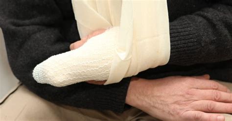 Broken Finger Cast