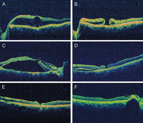 The Two Macular Holes That Required Second Intervention Patient 5 Had